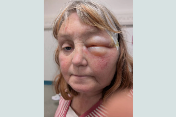 68 ára amma hlaut alvarleg brunasár eftir árás nágrannakonu